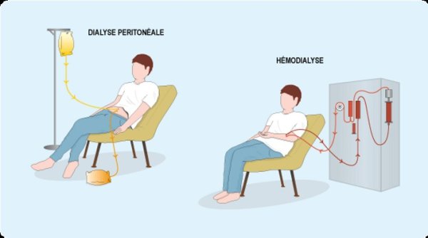 Pour le développement de la dialyse péritonéale qui désenclave la montagne